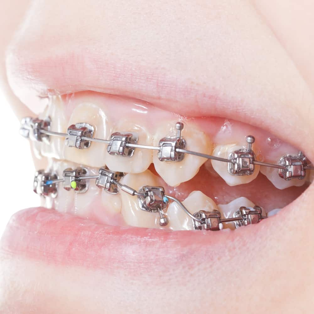 Orthodontics | Stilly Valley Dental