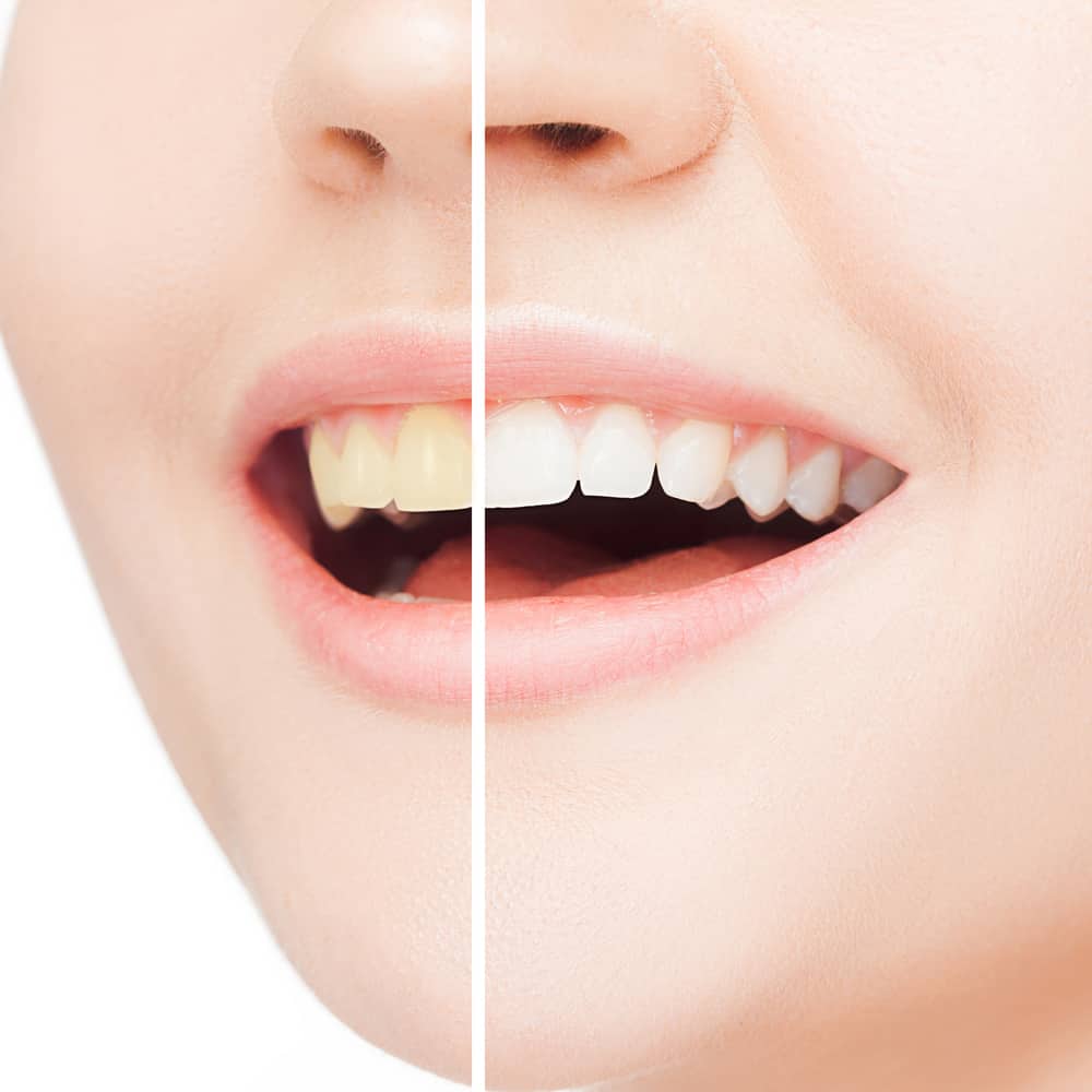 Teeth Whitening Solutions | Stilly Valley Dental