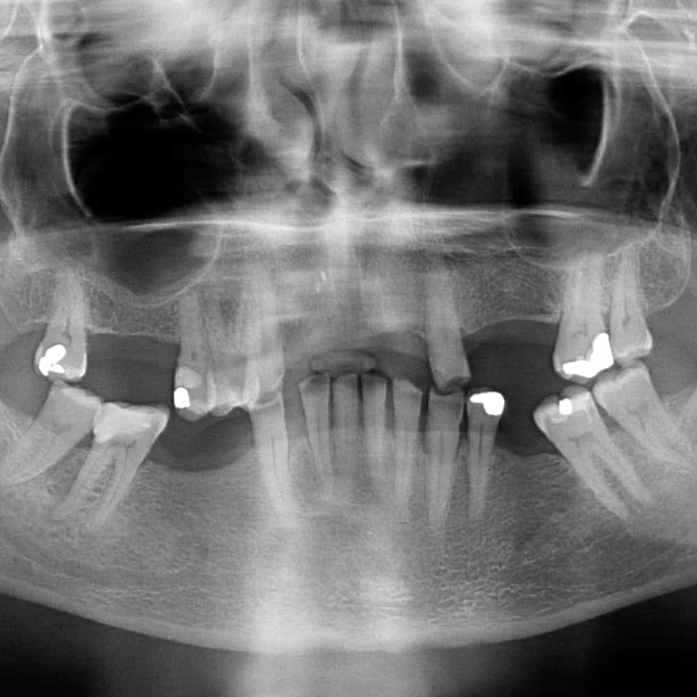 Digital X-rays | Stilly Valley Dental Digital X-rays | Stilly Valley Dental